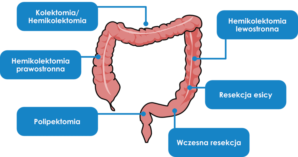 Wejdź do środka – zbadaj jelito – EuropaColon Polska